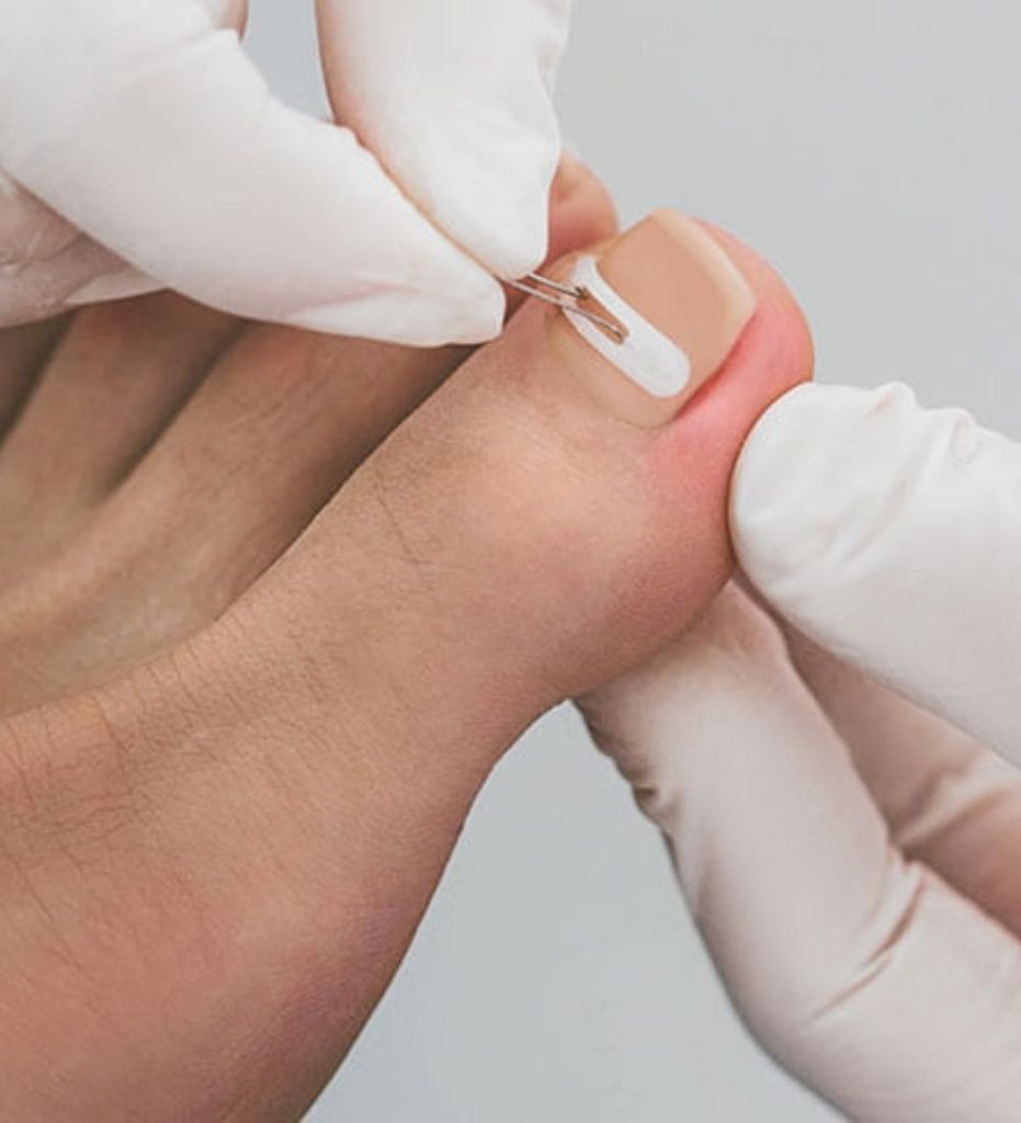 Ingrown Toenail Treatment - Dr. Şermin Filiz Acıpayam